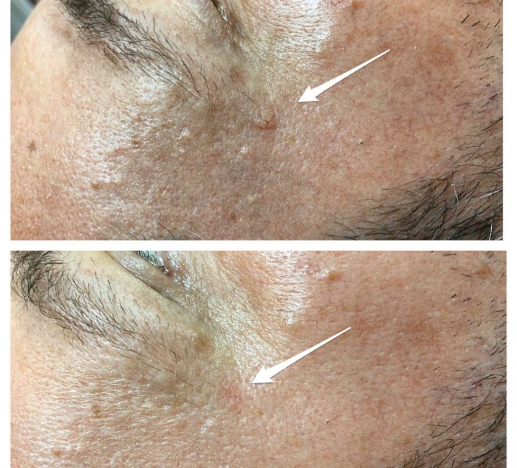 Skin Tag Removal | Electrocoagulation | BioCell Clinic Lagos